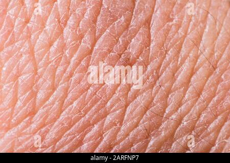 Skin close up. Dry human skin under microscope with eczema damage ...