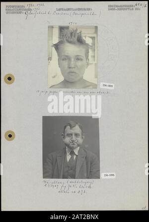 Occupational diseases at the glass factory in Leerdam Photo 1: Hands of ...