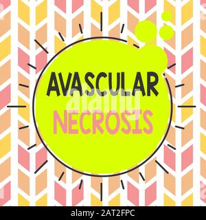Handwriting text Avascular Necrosis. Conceptual photo death of bone ...