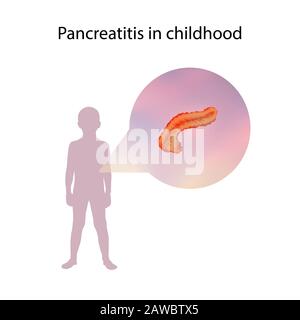 Acute pancreatitis, illustration Stock Photo - Alamy