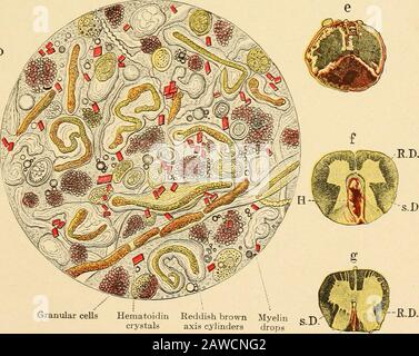 . Diseases of the nervous system . w hematoidin crystals. Only in afew ...