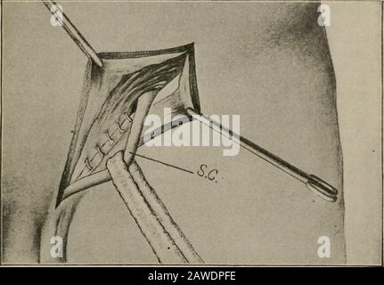 Operative surgery, for students and practitioners . ^ long to cover the ...