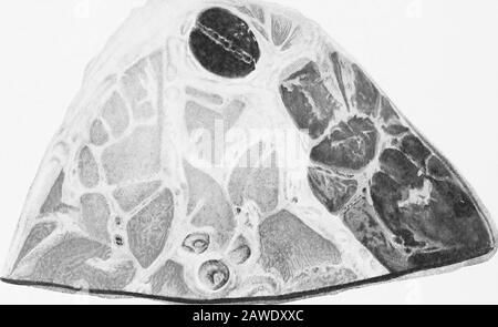 Pneumonia in a right lung (acute respiratory infection), revealed by ...