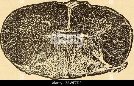 . Diseases of the nervous system . Fig. 101.—Tabetic Degeneration. cs ...