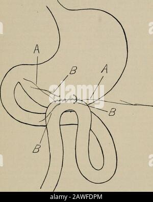Operative surgery, for students and practitioners . t. The Outlines of ...