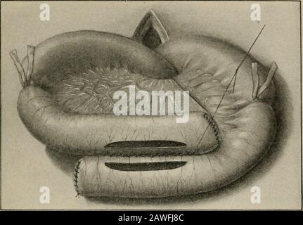 . Operative surgery, for students and practitioners . Lembert suturesof ...