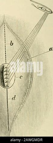 Intestinal Fistula Illustration Stock Photo - Alamy