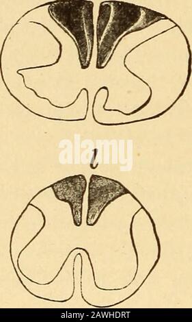 . Diseases of the nervous system . Fig. 101.—Tabetic Degeneration. cs ...