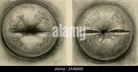The practice of surgery . eally poutings of the engorged LACERATIONS ...