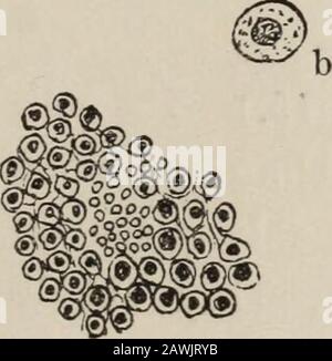 General surgery and pathology for dentists . B c. Fig. 8. GUMMA OF ...