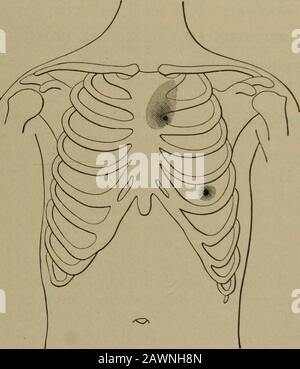 Physical diagnosis, including diseases of the thoracic and abdominal ...