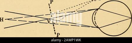 Skiascopy and its practical application to the study of refraction ...