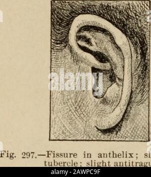 Nervous and mental diseases . Fie. 296.—Triplication of crura furcata ...