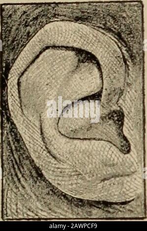 Nervous and mental diseases . Fig. 294.—Broad, band-like helix; no ant ...
