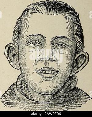 Nervous and mental diseases . Fig. 289.—Blainville ear : also excessive ...