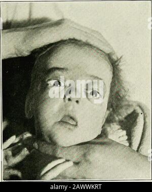 Raised skin swelling Stock Photo - Alamy