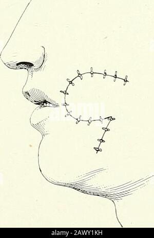 Surgical therapeutics and operative technique . e Vertical Section Fig ...