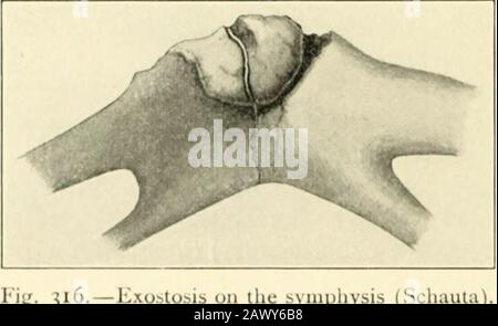 A textbook of obstetrics . g. 316. — Exostosis on the symphysis ...