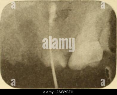Gutta percha root canal treatment process. Medically accurate tooth 3D ...
