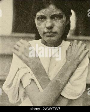 The endemic diseases of the southern states . ?Typic eruption on elbows ...