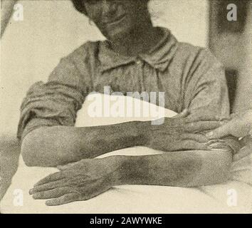 The endemic diseases of the southern states . ?Typic eruption on elbows ...