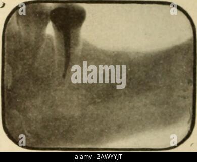tooth rootcanal treatment Stock Photo - Alamy