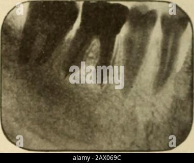 Diseases of the soft structures of the teeth and their treatment; a ...
