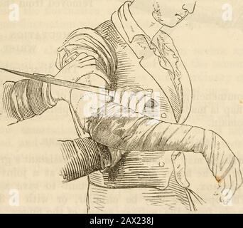 Amputation being performed in front of a hospital tent, Gettysburg ...