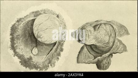 A textbook of obstetrics . Fig. III. — Decidua vera, decidua reflexa ...