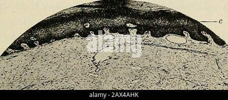 The pathology and surgical treatment of tumors . Fig. 4.—Prickle-cells ...