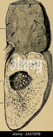 . Diseases of the gall-bladder and bile-ducts, including gall-stones ...
