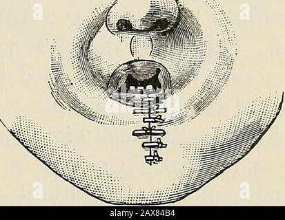 Sutured wound in the mouth after implant placement. Dental implants ...