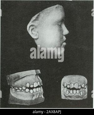 Methods of Teeth Correction Stock Photo - Alamy