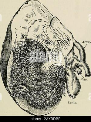 The pathology and surgical treatment of tumors . with the uterus, n ...