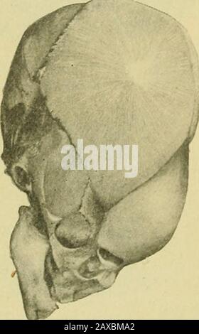 FETAL SHOULDER PRESENTATION Stock Photo - Alamy