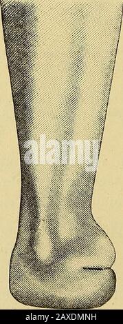 healed amputation stump Stock Photo - Alamy