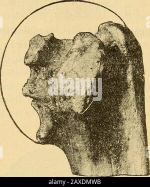 INFILTRATION IN A SHOULDER Stock Photo - Alamy