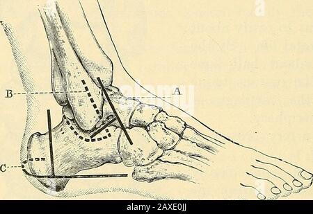 ankle wound suture Stock Photo - Alamy