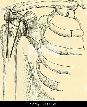 A manual of operative surgery . arm is at right angles to the body,and ...