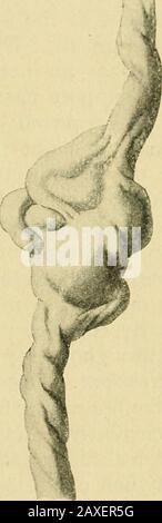 A true knot in the umbilical cord at birth Stock Photo - Alamy