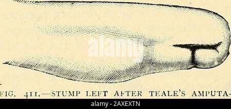 . Manual of operative surgery. the wound with sutures after providing ...