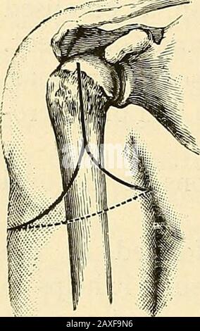 A manual of operative surgery . arm is at right angles to the body,and ...