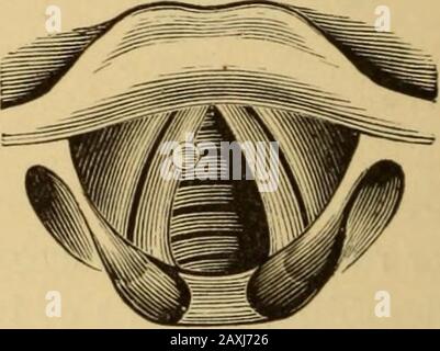 VOCAL CORD POLYP Stock Photo - Alamy