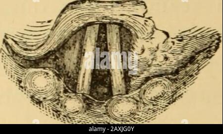 Primary Syphilitic Chancre Stock Photo - Alamy