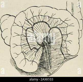 . On retro-peritoneal hernia . Fig, i6.—Left Duodenal Hernia, pushing ...