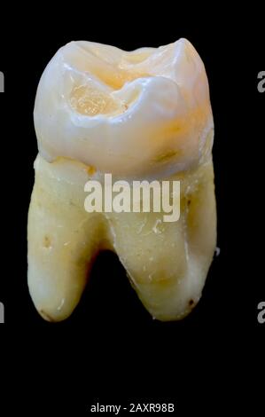 This is a side view of my wisdom tooth that had to be extracted due to ...