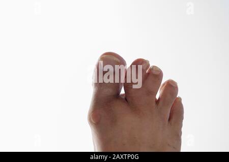 Human foot with conjoined toes Stock Photo - Alamy