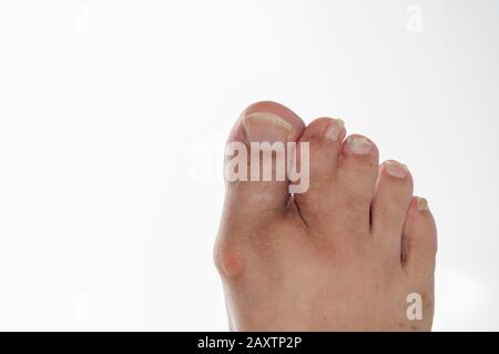 Human foot with conjoined toes Stock Photo - Alamy