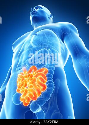 Illustration of an inflamed small intestine Stock Photo - Alamy