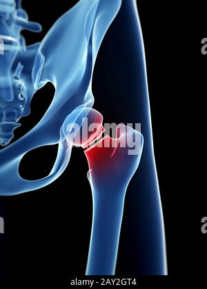 FRACTURED HIP, X-RAY Stock Photo - Alamy